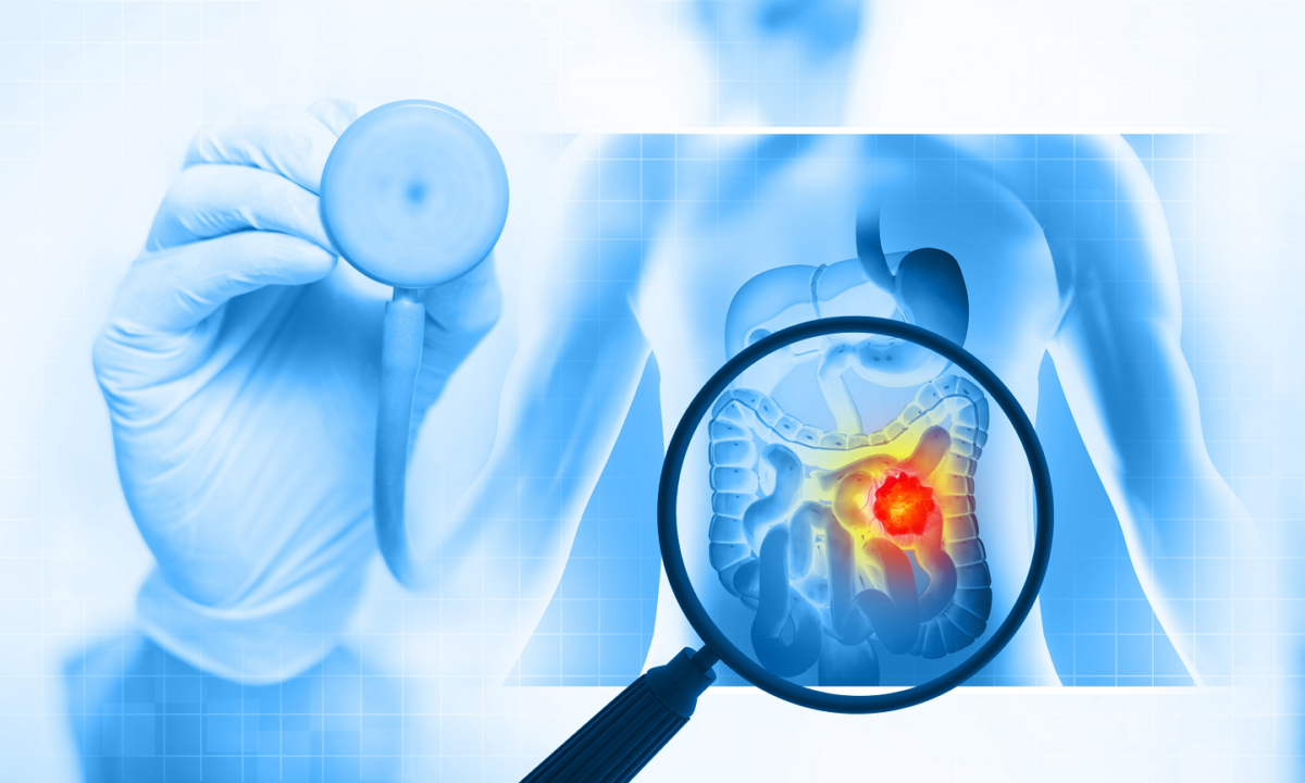 Tumore del colon-retto: diagnosi e rilevamento tramite analisi del ...